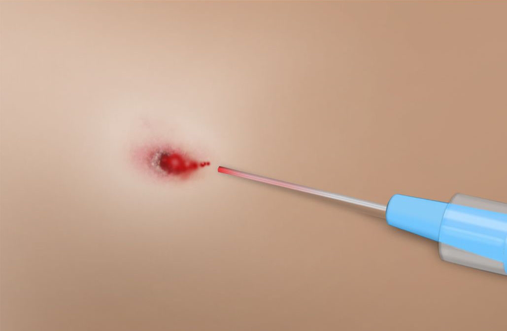 Challenges in Peripheral IV Access